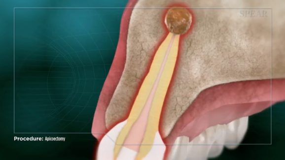 Apicoectomy - EOI NYC