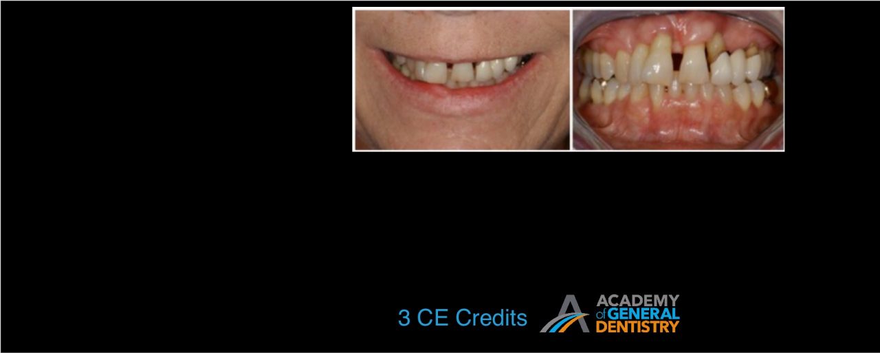 Tooth Extrusion