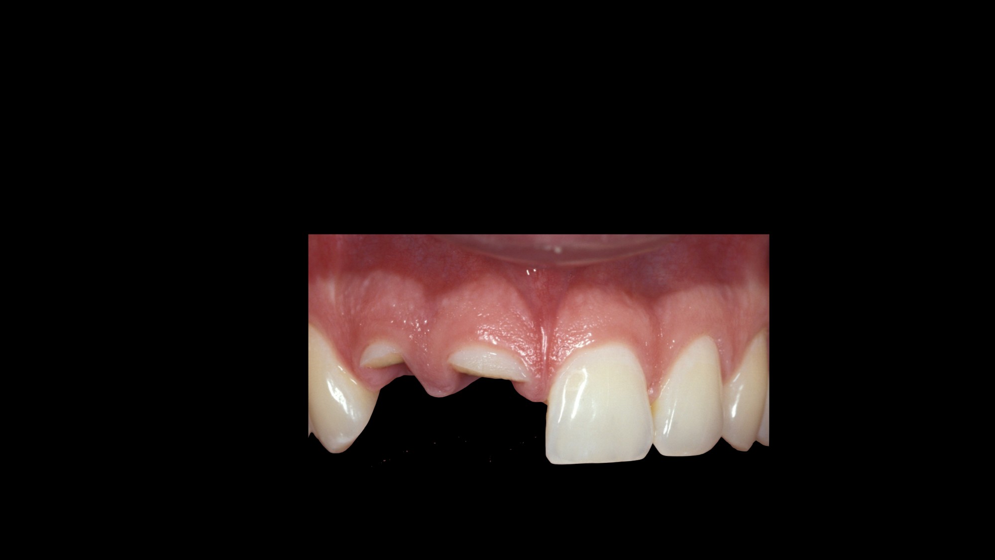 Anterior Trauma and Fractured Teeth - EOI NYC